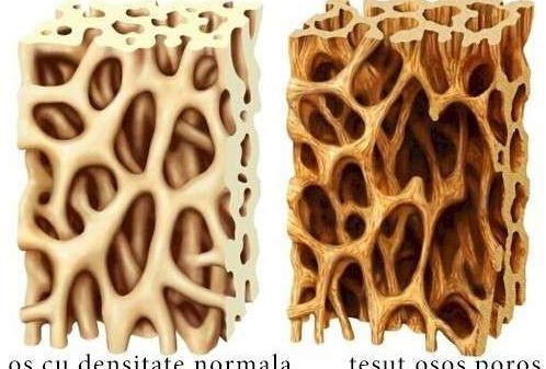 Osteoporoza reprezinta scorbutul oaselor, nu deficienta de calciu ...